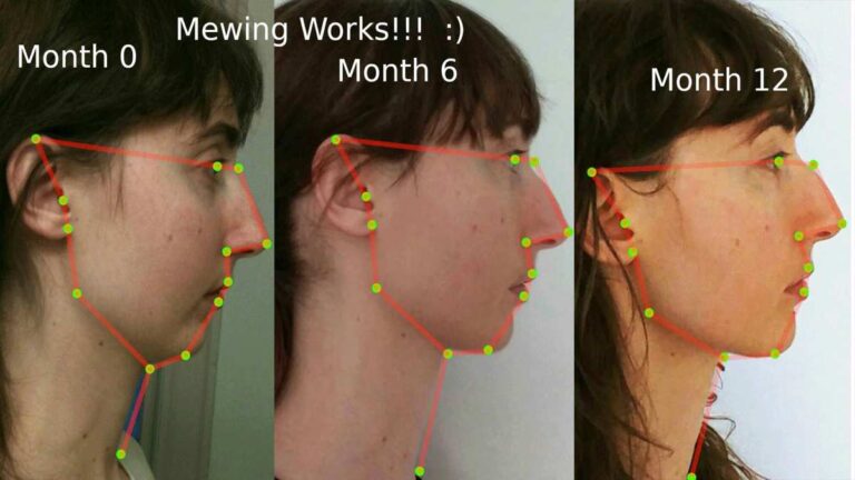 Divine mewing exercises - Hitting the chin - Visual V - SIXMD ...