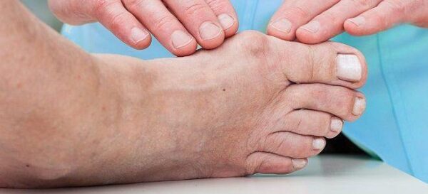 Gout and what you should know - SIXMD - Vietnamese Online Shop
