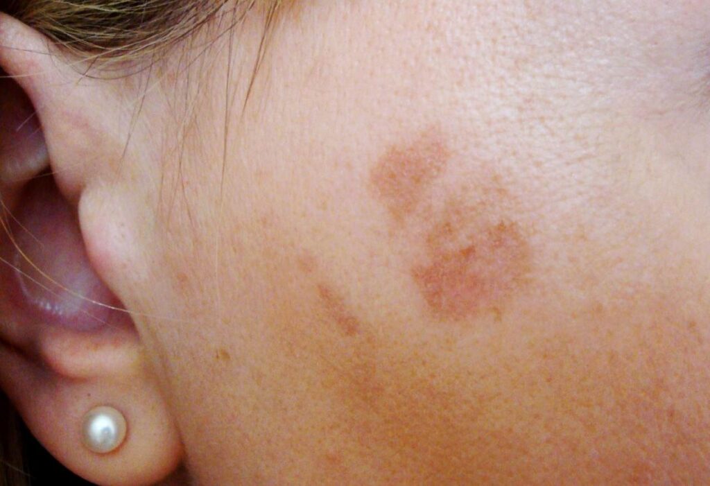 Why does the skin darken when using Hydroquinone? - SIXMD - Vietnamese ...